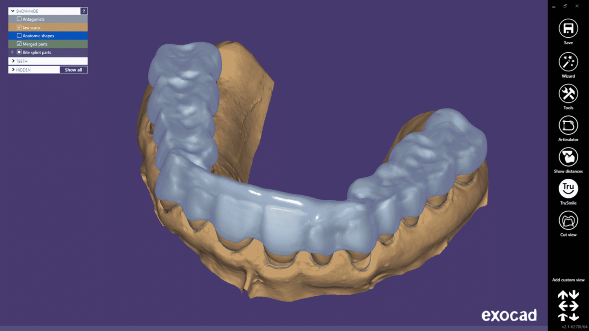 Bite Splint Module | Evolve Dentistry